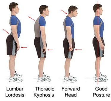 Can Chiropractic Improve Posture? - Tidal Chiropractic
